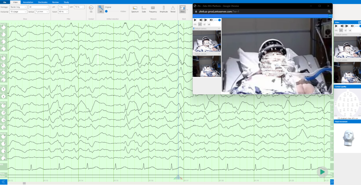 Enhancing Diagnostic Precision: Exploring the Role of Video EEG