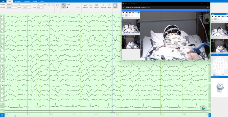 Enhancing Diagnostic Precision: Exploring the Role of Video EEG