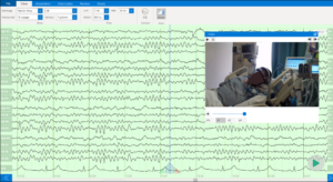 Enhancing Diagnostic Precision: Exploring the Role of Video EEG