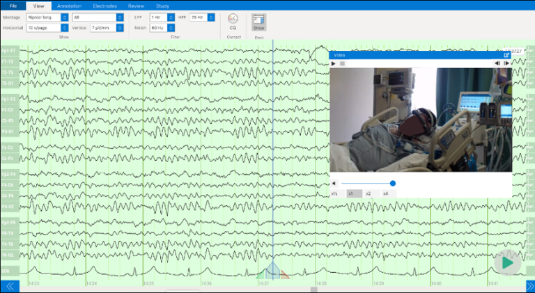 Enhancing Diagnostic Precision: Exploring the Role of Video EEG