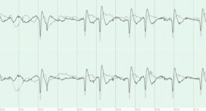 How Digital EEG Filters Impact EEG Signal Morphology | Zeto EEG