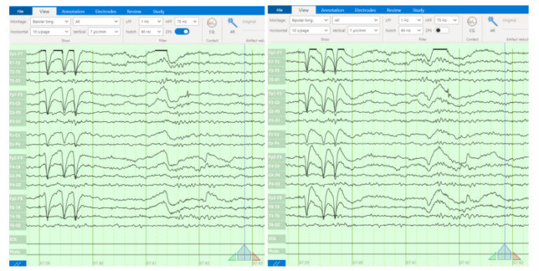 How Digital EEG Filters Impact EEG Signal Morphology | Zeto EEG