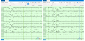 How Digital EEG Filters Impact EEG Signal Morphology | Zeto EEG