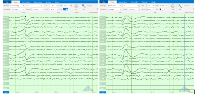 How Digital EEG Filters Impact EEG Signal Morphology | Zeto EEG