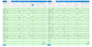 How Digital EEG Filters Impact EEG Signal Morphology | Zeto EEG