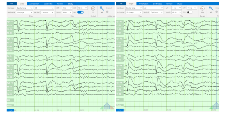 How Digital EEG Filters Impact EEG Signal Morphology | Zeto EEG