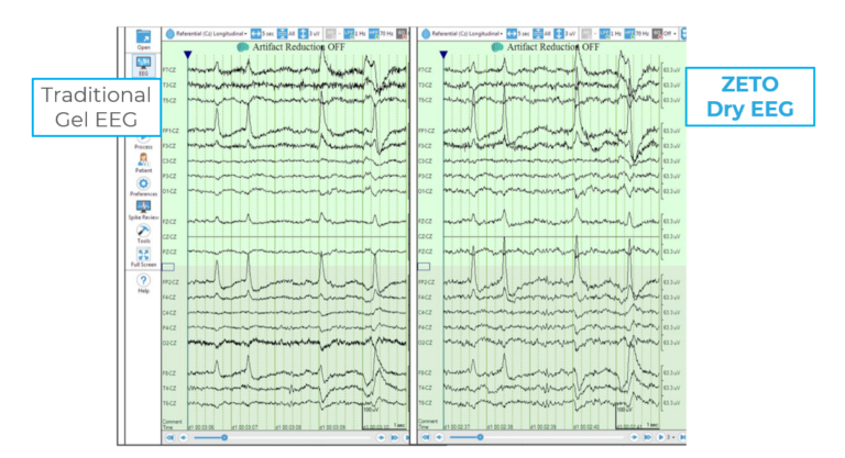 7 Core Benefits of Portable EEG for Growing Hospitals | Zeto EEG